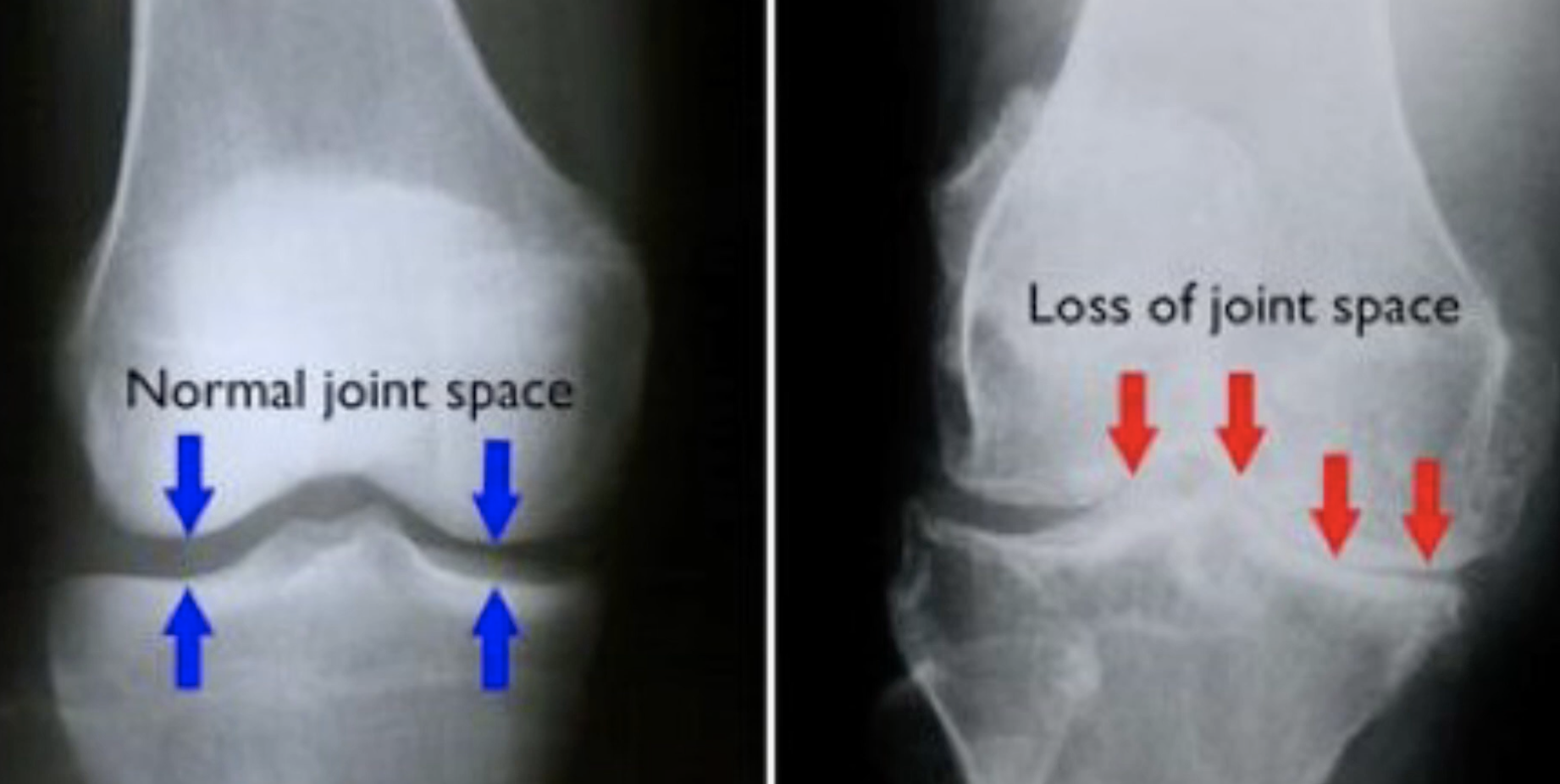 X光片中的黑色與白色代表甚麼？ | am730